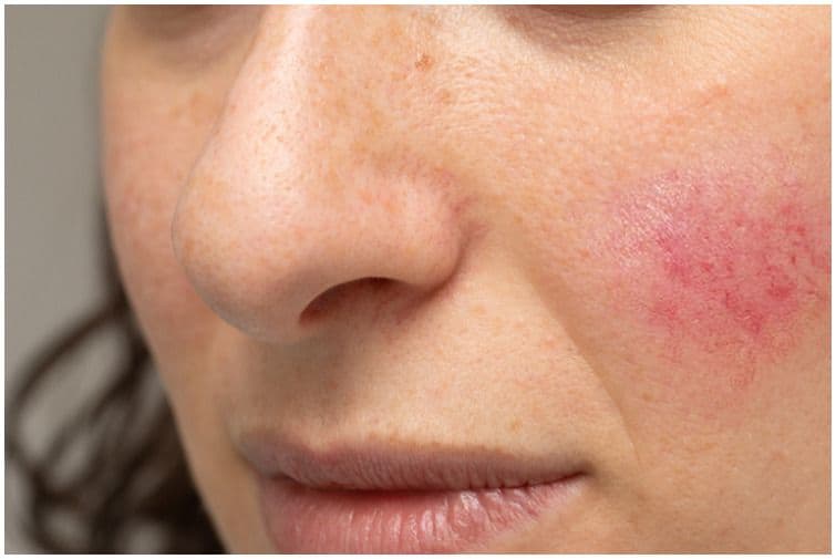 Redness Around Nose, Mouth, Chin, Cheeks, Eyes – Causes & Remedies ...