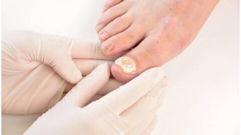 Kerydin vs Jublia For Nail Fungus – Cost & Effectiveness + Alternatives