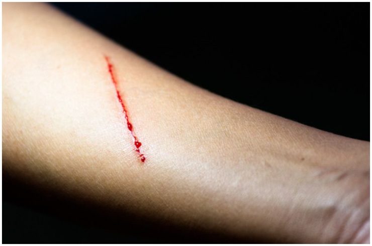 Mupirocin vs Neosporin – Comparison of Ointments For Wound Infection