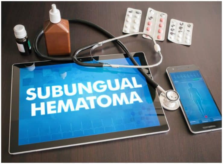 Subungual Hematoma vs Melanoma - Differences - Health Guide Net