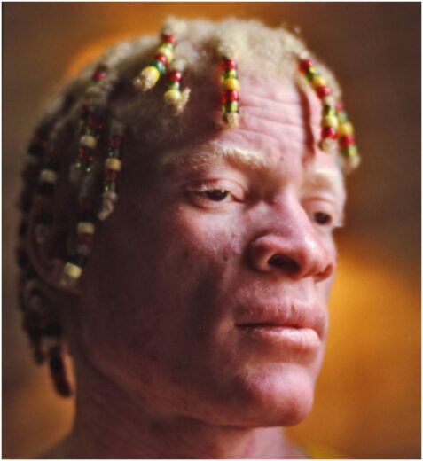 Famous People with Albinism - Health Guide Net