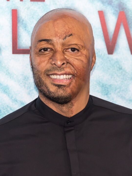 Celebrities with Facial Scars - Health Guide Net